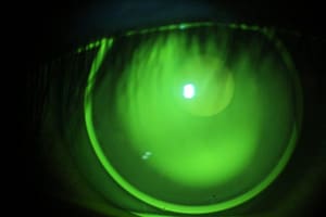 Contact Lens for Keratoconus: Soft Custom Lens vs RGP vs Scleral Lenses ...