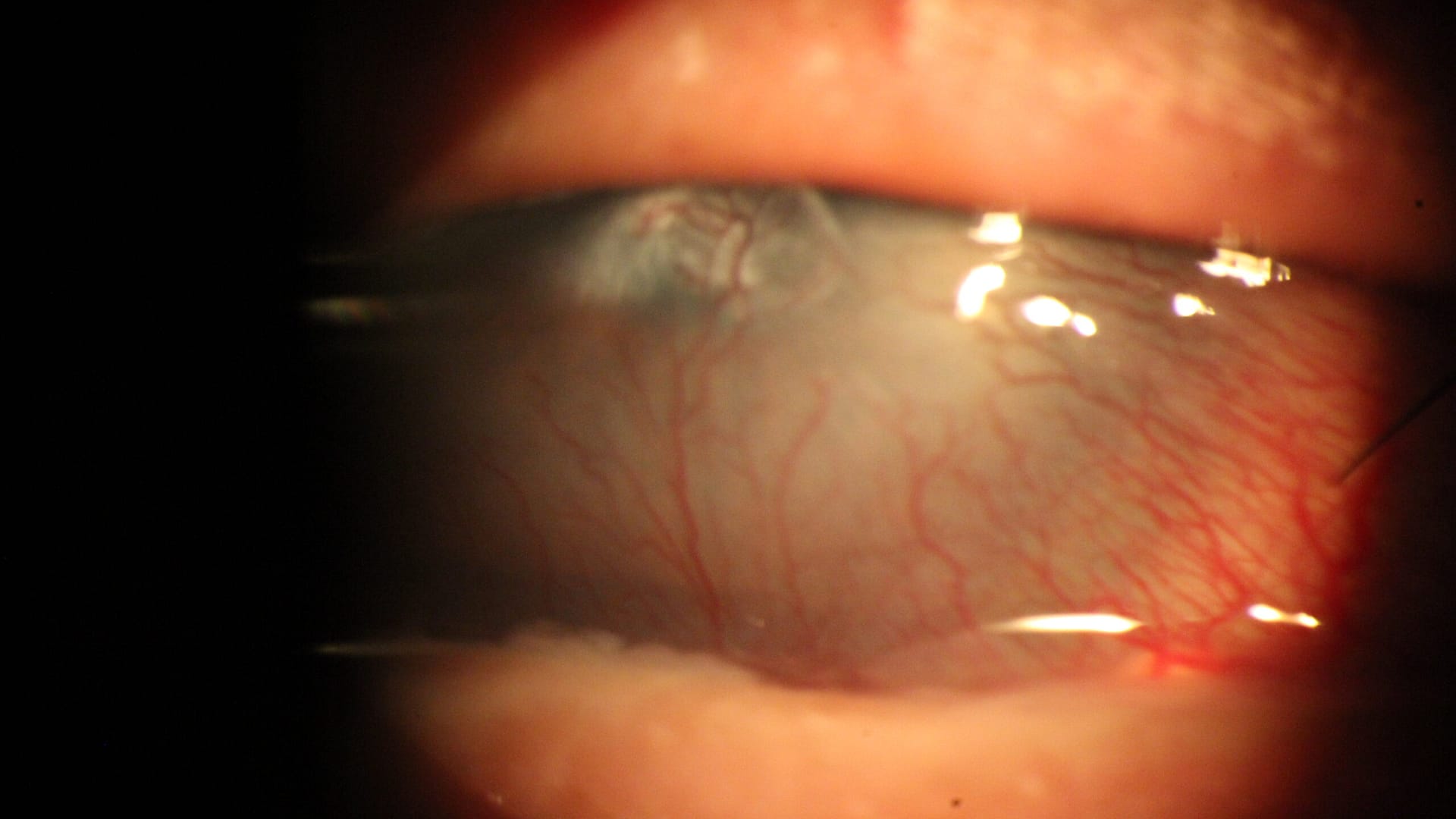 Vision Improvement in Stevens-Johnson Syndrome - Gold Heart Optical Centre