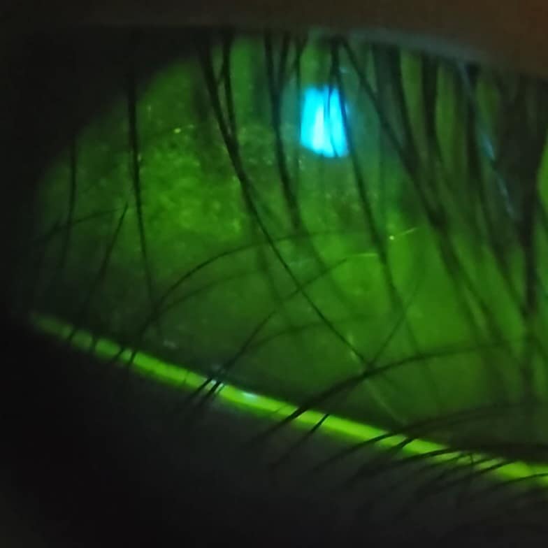 Eyelashes Rubbing the Eyes - Gold Heart Optical Centre